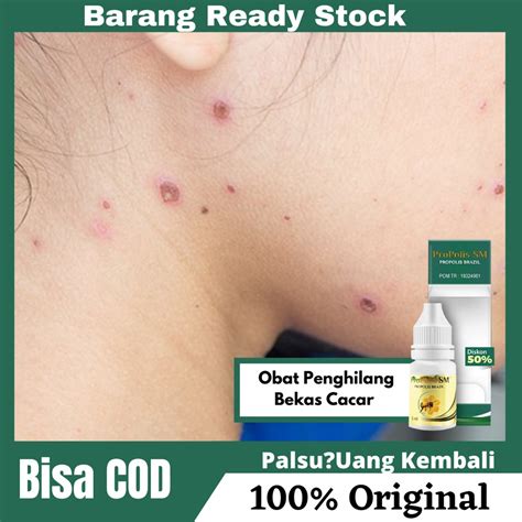 Jual Obat Penghilang Bekas Cacar Bekas Luka Cacar Di Wajah Kaki