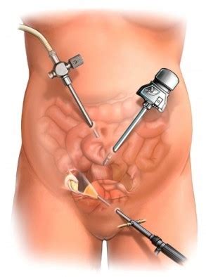 Recovery After Partial Hysterectomy