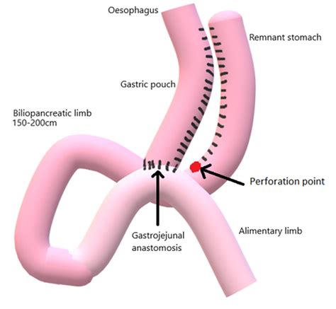 Gastric Remnant Perforation After Single Anastomosis Gastric Bypass