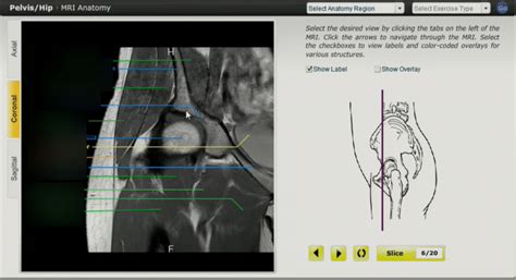 Hip MRI Frontal Plane Slice 5 Diagram Quizlet