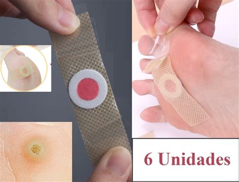 Tratamento Para Olho De Peixe No Pé
