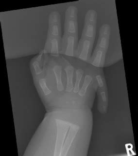 Extra Digits Congenital Hand And Arm Differences Washington