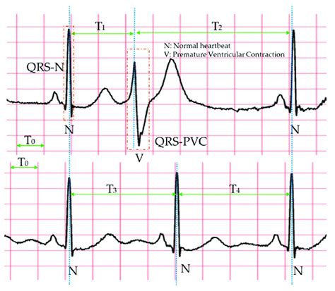 Premature Ventricular Contractions PVCs ECG Example 3 50 OFF