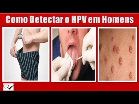 Vírus do papiloma humano Como Detectar o HPV em Homens YouTube