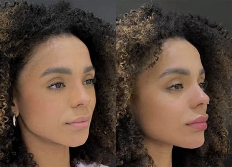 Antes e depois Brunna Gonçalves faz harmonização facial