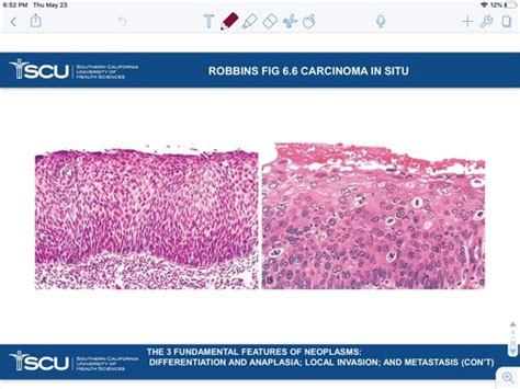 Pathology I Neoplasia Flashcards Quizlet