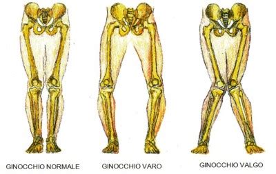 Ginocchio Varo E Valgo Patologieortopediche Dott Fabrizio