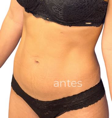 Mini Abdominoplastia tudo que você precisa saber
