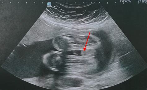 Chographie Mois Echographie Mois Chographie Mois