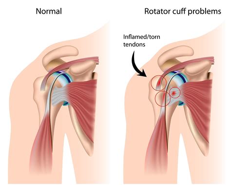 Shoulder Impingement Syndrome Bodychek