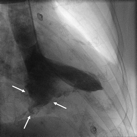 Left Ventricular Free Wall Rupture During Ventriculography JACC