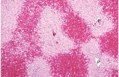 Liver Pathology Flashcards Quizlet
