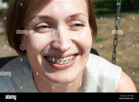 Braces Mouth Woman Hi Res Stock Photography And Images Alamy