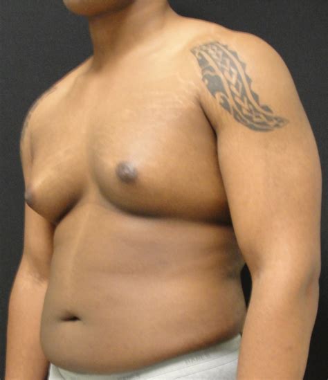 Male Breast Reduction Before And After Photos By Dzifa Kpodzo MD
