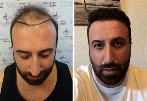 Artin A Before After Pictures 3500 Grafts Elithair