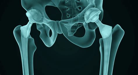 Colocação de Próteses Dr Carlos Macedo Clínica e Cirurgia do