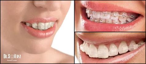 Metal Braces Ceramic Braces Cost In Chennai India By Drsmilez2018