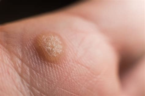 What Does A Wart Look Like On Palm Of Hand At Christopher Gibson Blog