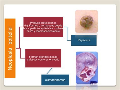 Neoplasias Benignas Y Malignas PPT