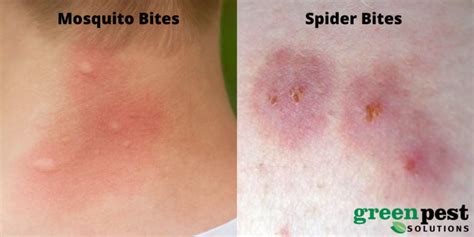Difference Between A Mosquito Bite And A Spider Bite Differences Finder