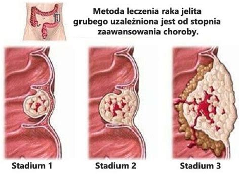 Leczenie Raka Jelita Grubego Proktosonomed