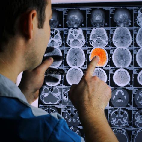 Balayage De CT Du Cerveau Image De Rayon X Du Cerveau Course Ischémique