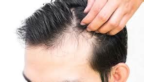 Perte De Cheveux Pour Les Hommes Causes Et Soins