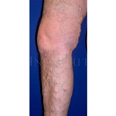 Fotos varices con láser antes y después IML