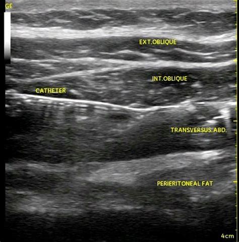 Ultrasound Guided Transversus Abdominis Plane TAP Block NYSORA NYSORA