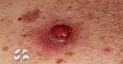 Dermnet Amelanotic Nodular Melanoma Image