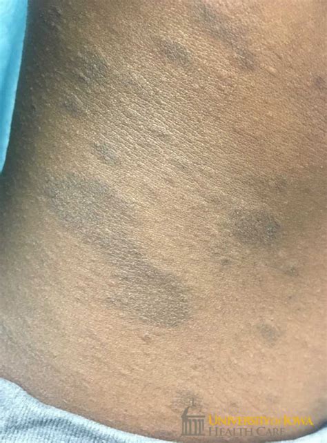 Gray Brown Ovoid Scaly Papules And Plaques On The Abdomen Click