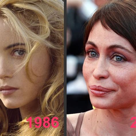 Emmanuelle Béart et la chirurgie esthétique Son avant après en photos