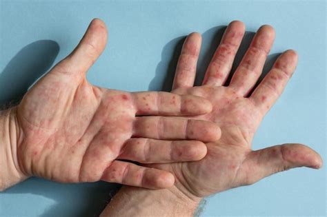 Premium Photo Painful Rash Red Spots Blisters On Hand Close Up