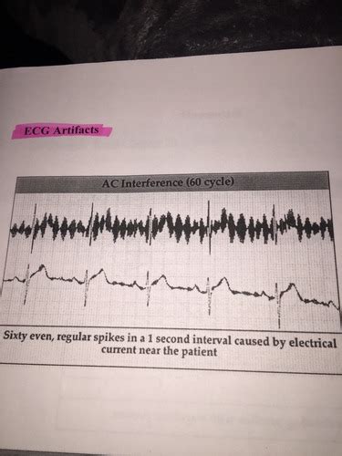 ecg artifacts flashcards quizlet