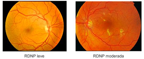Retinopatía diabética