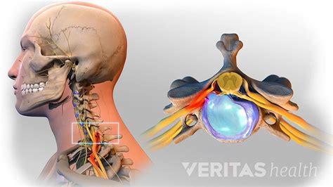 Columna Activa Síntomas De Hernia Cervical 58 OFF