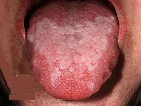 Oral Lichen Planus Causes Symptoms Prognosis Diagnosis Treatment