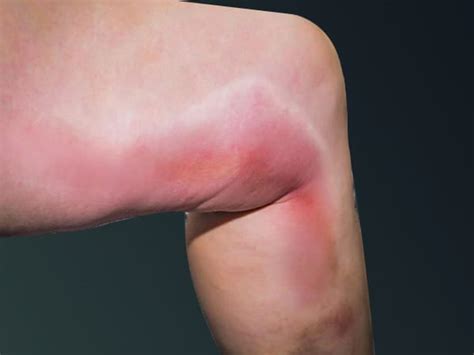 Phlebitis Arm Treatment