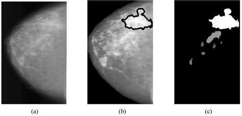 algorithms free full text breast cancer detection with gabor features from digital mammograms
