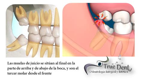 Truedent Cuando Extraer Las Muelas Del Juicio