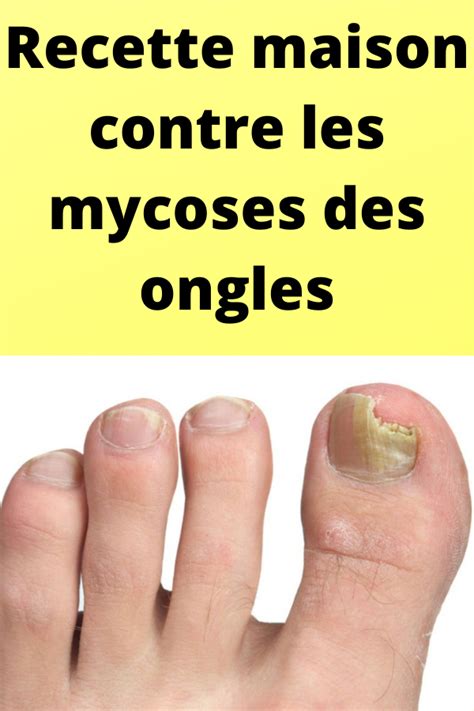 Recette Maison Contre Les Mycoses Des Ongles Artofit