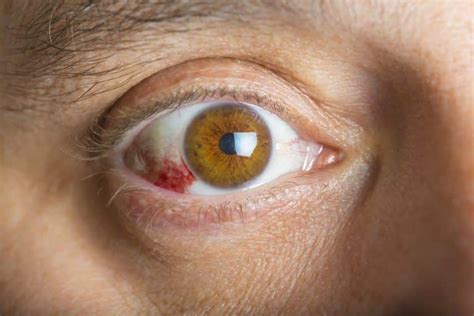 Qué son los Derrames Oculares Área Oftalmológica Avanzada