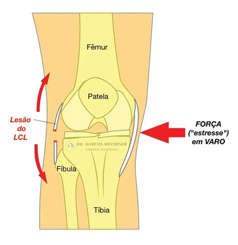 Lesão do Ligamento Colateral Lateral do Joelho Saiba Mais