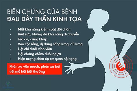 Đau thần kinh tọa Dấu hiệu triệu chứng và phương pháp điều trị WHO