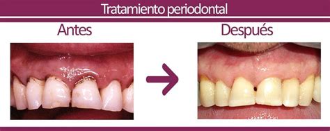 Cirugía periodontal Dentisalut