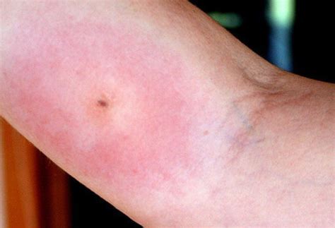 What Does A Spider Bite Look Like Pictures And Symptoms