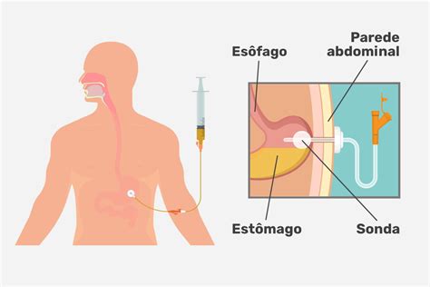 Gastrostomia o que é como alimentar e cuidados a sonda Tua Saúde