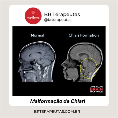 O que é a Malformação de Chiari BR Terapeutas