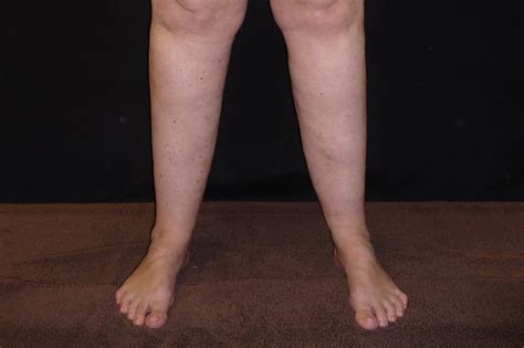 Lipoedema Nhs App
