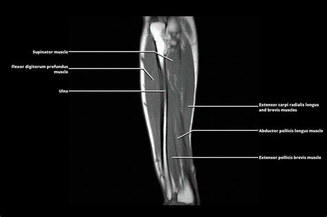 Forearm Muscle Anatomy MRI